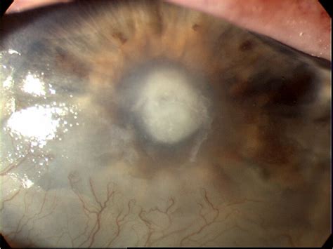 Corneal Ulceration In Bacterial Keratitis Note There Is An Epithelial Download Scientific