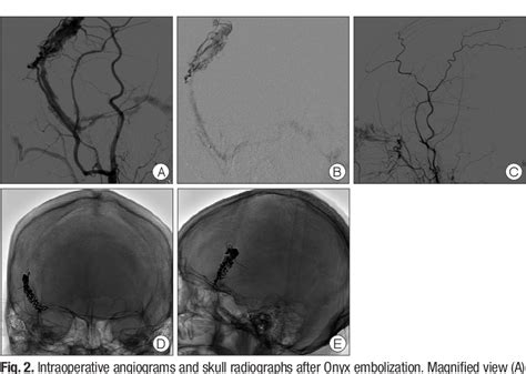 Figure 2 From A Case Of Intraosseous Dural Arteriovenous Fistulas Involving Diploic Vein Treated