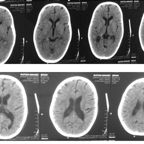 Ct Brain Showing Normal Findings No Abnormal Density Download Scientific Diagram