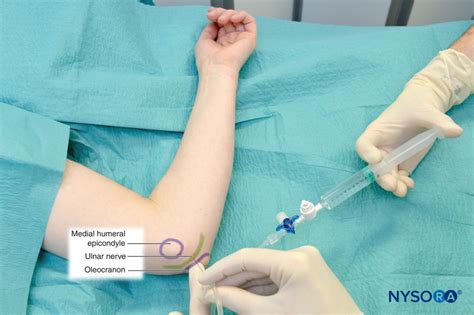 Anesthesia Nerve Block Procedure At Hayley Forster Blog