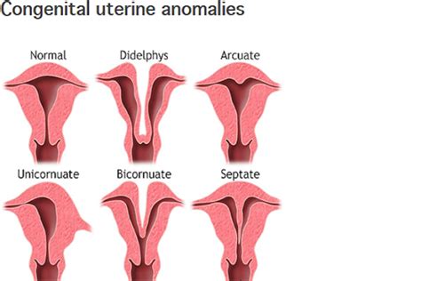 11 Abnormal Uterus And Miscarriage Risk Ideas Build A Harmonious