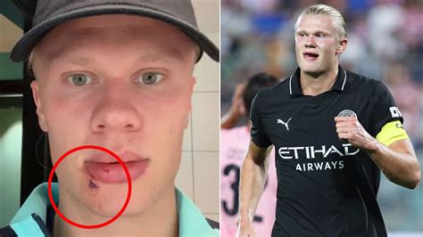 What Has Happened To Erling Haalands Face