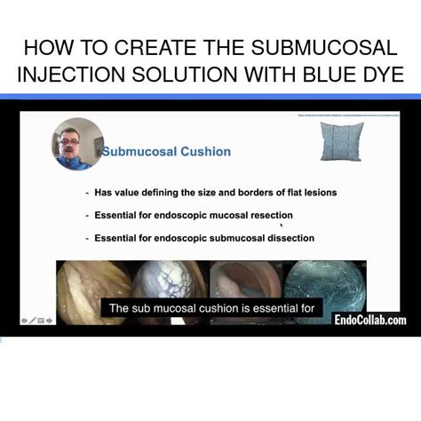[video] Endocollab™ Gi Endoscopy Education On Linkedin How To Create The Submucosal Injection