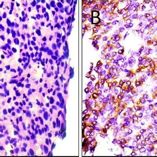 Epithelioid GIST A Cellular Tumor With Sheets Of Round To Ovoid Download Scientific Diagram