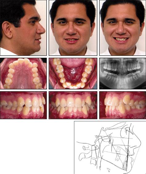 Upper Premolar Extraction Technique At Aidan Zichy Woinarski Blog