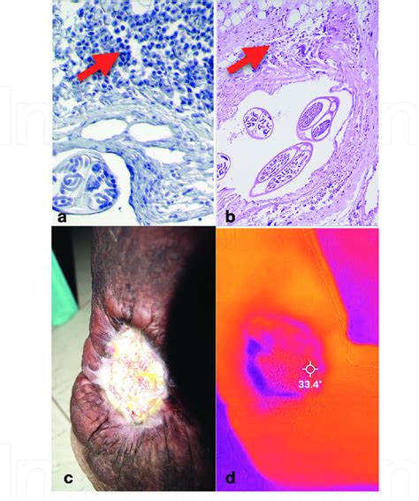 Filarial Infections And Consequences A Organised Lymphoid Aggregates Download Scientific