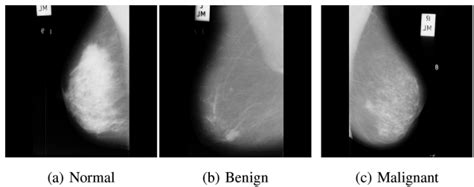 Early Breast Cancer Diagnostics Based On Hierarchical Machine Learning Classification For