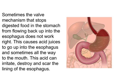 nissen fundoplication