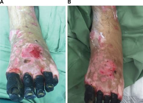 Treatment Of Hypergranulation Tissue In Burn Wounds With Topical