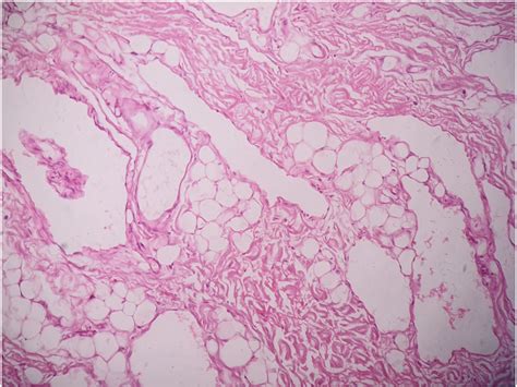 Histopathology Of The Excised Specimen Download Scientific Diagram
