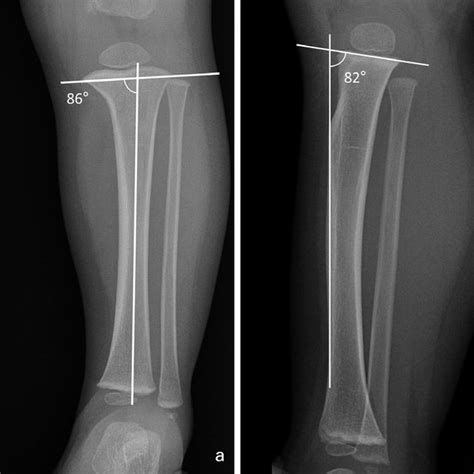 Pdf Initial Angular Deformity And Its Recovery Of The Proximal Tibial Metaphyseal Fracture