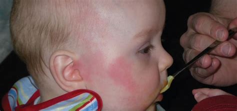 Tratamiento Fisioterapéutico Para Neuralgia Del Auriculotemporal Efisio Fisioterapia Madrid