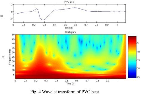 Figure 1 From Wavelet Power Spectrum Analysis For Pvc Discrimination Semantic Scholar