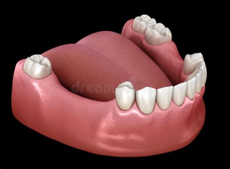 Removable Partial Denture Mandibular Prosthesis Medically Accurate 3d Illustration Of