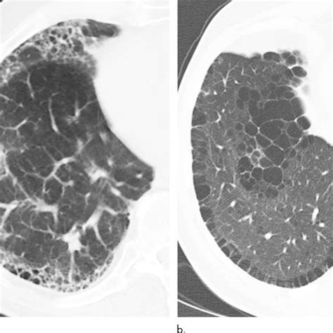 Honeycomb Cysts And Paraseptal Emphysema A Zoomed View Of Axial Ct