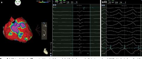 Figure 1 From Endoepicardial Ablation Of Ventricular Arrhythmias With Contact Force Sensing