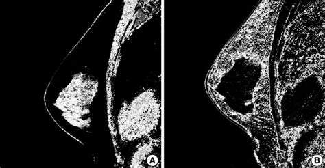 Fibroglandular Tissue Volume Assessment Using Fcm Clustering Breast Download Scientific Diagram
