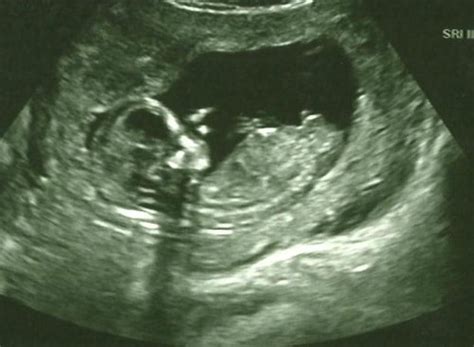 NT Scan Gender Right Or Wrong BabyCenter