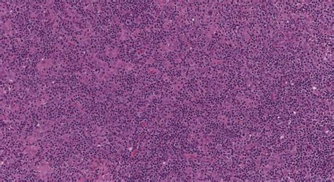 Ebv Positive Diffuse Large B Cell Lymphoma Ottawa Atlas Of Pathology