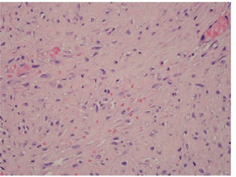 Benign And Reactive Stromal Lesions Basicmedical Key