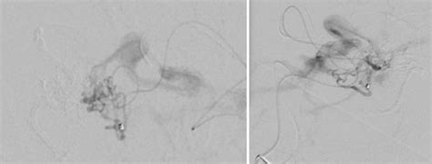 Temporal Avm Embolization Via Double Access