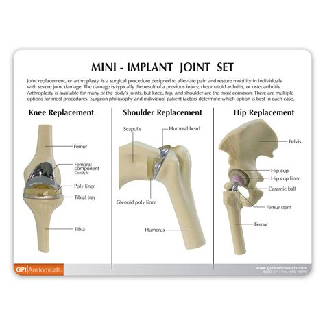 Mini Implant Joint Set