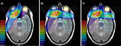 Transverse View Of Dose Distribution Around The Target Volume At A