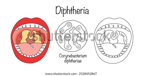 Infectious Disease Caused By Bacterium Corynebacterium Stock Vector
