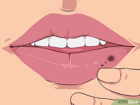 Ways To Perform Melanoma Skin Checks WikiHow Health