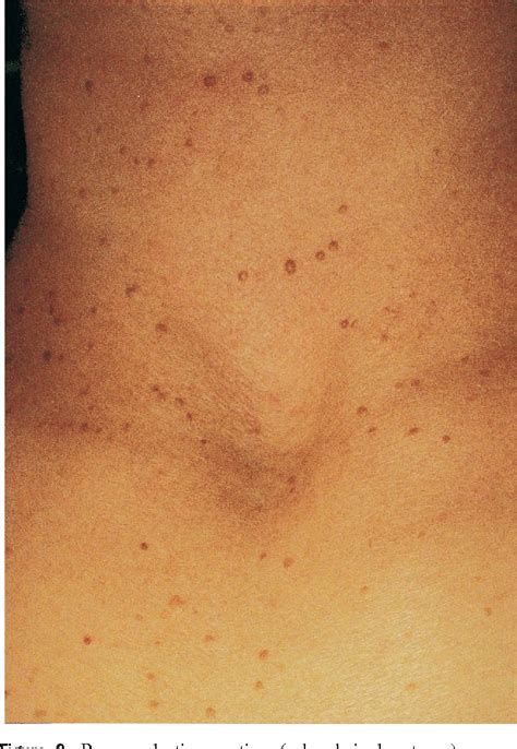 Figure 2 From The Leser Trelat Sign In Association With Carcinoma Of