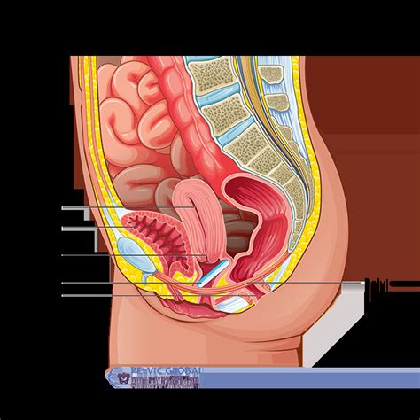 Pelvic Organ Prolapse After Hysterectomy