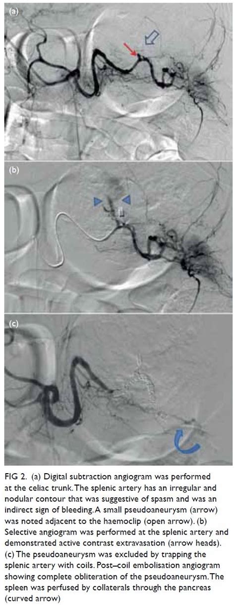 Transcatheter Arterial Embolisation Can Be The Standard Treatment For Non Variceal Upper