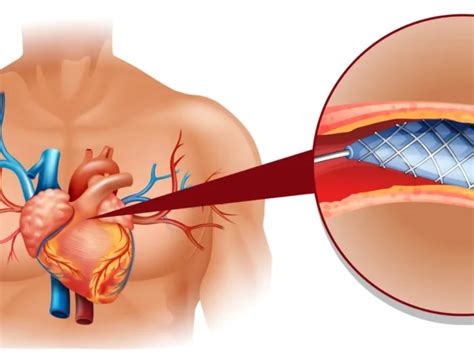 Know The Symptoms Of Diastolic Dysfunction Dr Raghu