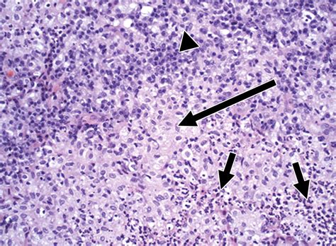 Granulomatous Mastitis