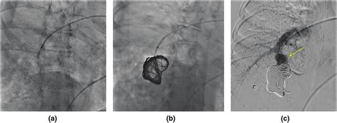 Digital Angiography Selective Catheterisation Of The Pseudoaneurysms