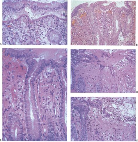 Ischemic Colitis Abdominal Key