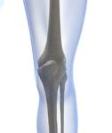 The Arthrofibrosis Foundation Articles