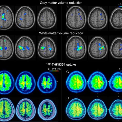 Representative Relation Between Thk5351 Uptake And Gray Or White Matter