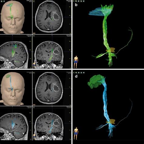 Pdf Diffusion Tensor Imaging Fiber Tracking Using Navigated Brain