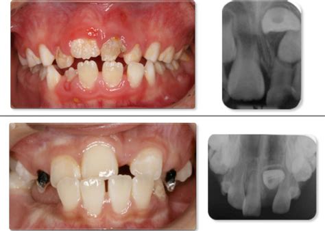 Root Dilaceration Treatment Favourite Dentistry
