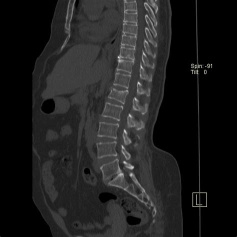 Compression Fracture Xray Images At Benjamin Downie Blog