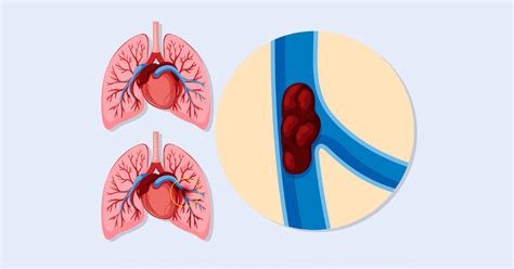 What Happens If Blood Clot Goes To Lungs At Ruth Leet Blog