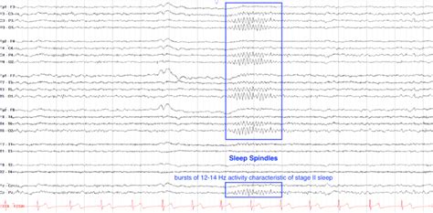 Sleep Spindles Neuro Pathway