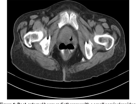 Figure 1 From The Role Of Surgery In Locally Advanced Carcinoma Of