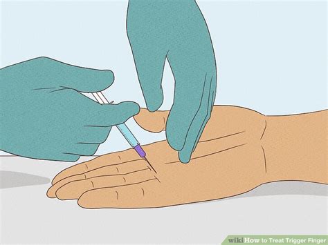 How To Treat Trigger Finger Steps With Pictures WikiHow
