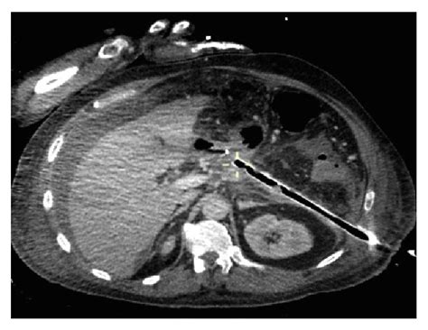 Minimally Invasive Necrosectomy Techniques In Severe Acute Pancreatitis