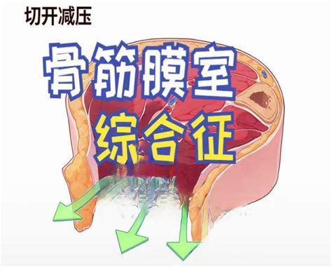 儿童骨筋膜室综合征，你知道什么处理吗？ 好医术文章 好医术 赋能医生守护生命