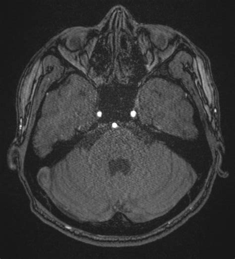 Basal Ganglia Subacute Infarct Radiopaedia 80201 93521 Axial Mra Nc