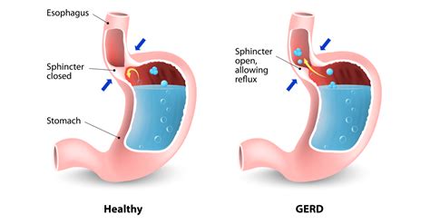 Antireflux Surgery Gerd Mithani Md