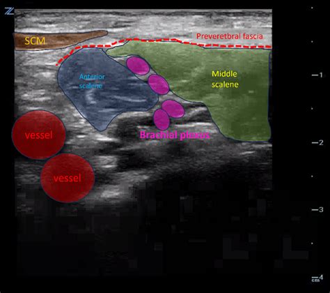 Votw Interscalene Brachial Plexus Block — Maimonides Emergency Medicine Residency